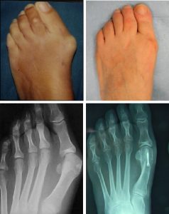 Alluce valgo prima e dopo: tutte le soluzioni per intervenire