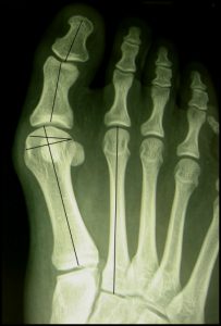 Alluce valgo prima e dopo: tutte le soluzioni per intervenire